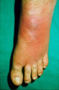 Selülit nedir? - Kimlerde görülür? - Nasıl tedavi edilir?